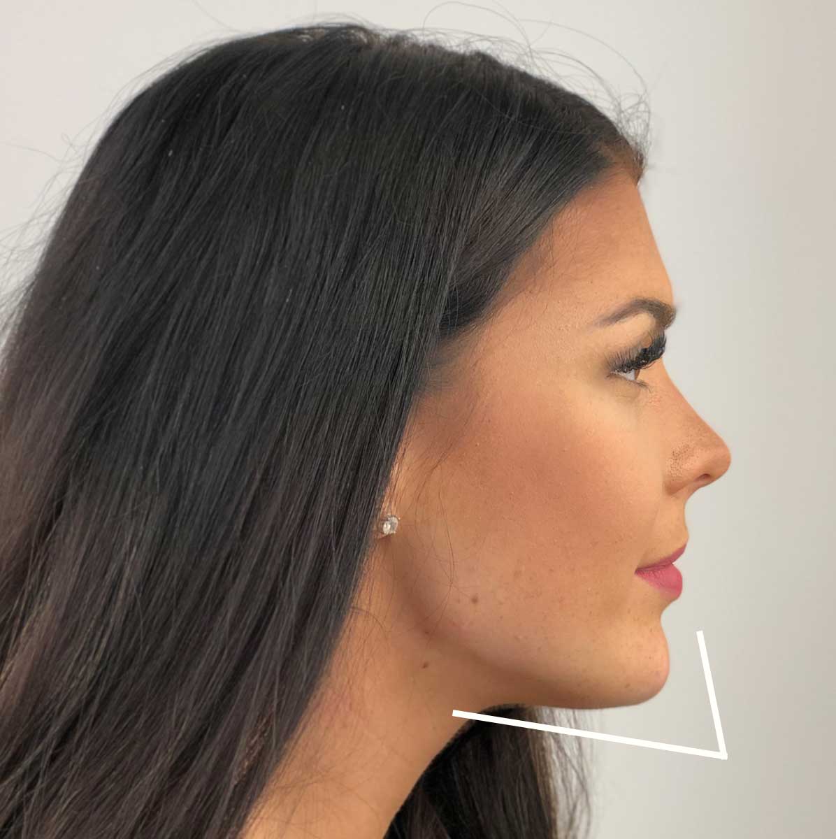 Jawline Contouring mit Filler Radiesse® – Dr. Steidl Aesthetics